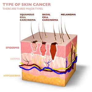 Basal Cell Carcinoma Stages Moffitt