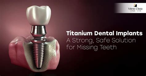 Titanium Dental Implants Restore Your Smile Naturally Vitrin Clinic