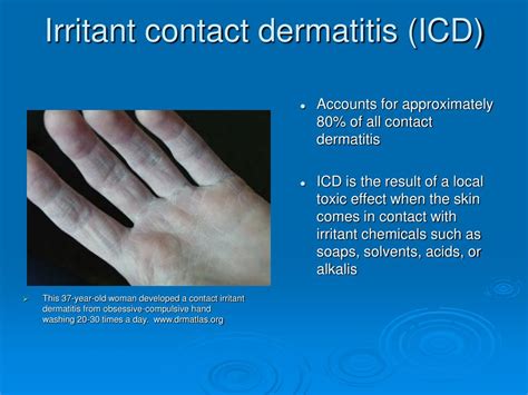 Contact Dermatitis Pic Contact Dermatitis Rash Symptoms Causes And
