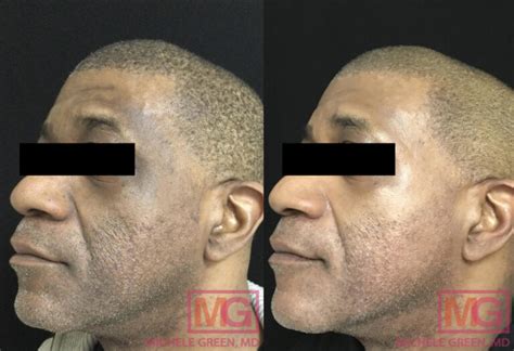 Cosmelan Cosmelan Peel And Melasma Treatment Nyc