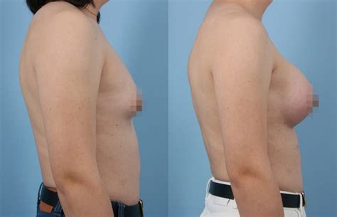 Transgender Breast Augmentation Newport Beach