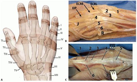 Repair Following Traumatic Extensor Tendon Disruption In The Hand