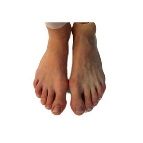 Silicone Partial Foot Prosthesis Myoelectric At ₹ 35000piece In New Delhi