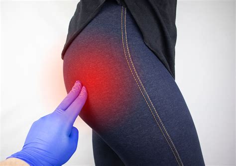 Dolor En Las Nalgas ¿por Qué Se Produce Dr Italo Pisani