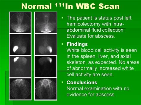 Leukocyte Imaging The Diagnostic Applications Of Labeled Wbcs