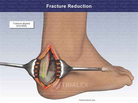 Fracture Reduction Trialquest Inc