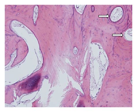 Right Postauricular Bulging Mass Which Is Asymptomatic Hard And