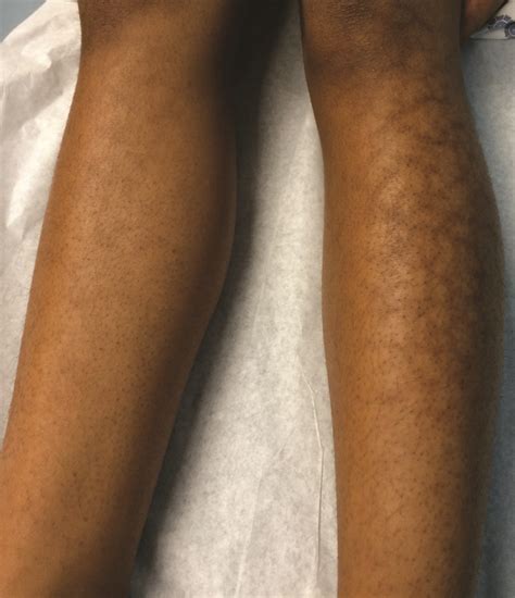 Reticular Hyperpigmentation On The Lower Legs Mdedge