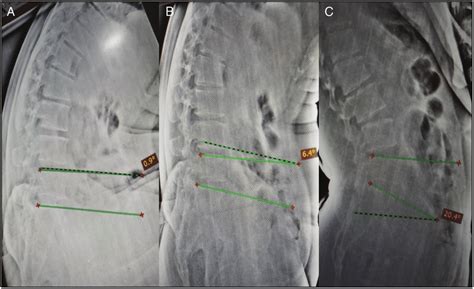 Angular Measurements Of The Flexion And Extension Radiographs A