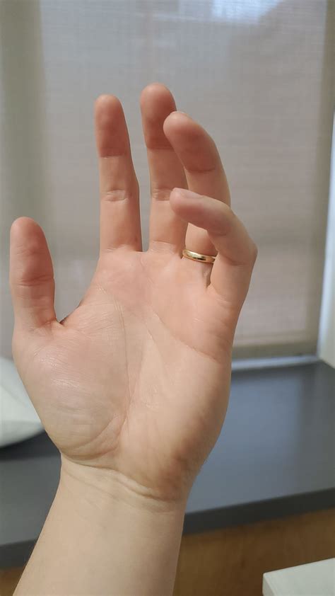 Transposition Surgery For Both Arms Due To Claw Thoughts R