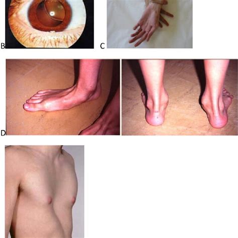 Typical Clinical Manifestations In Syndromic Forms Of Heritable
