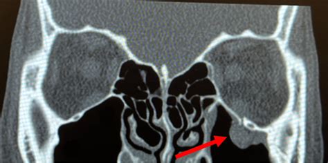 Do Not Fall For This Diagnostic Challenges In Orbital Floor Fractures