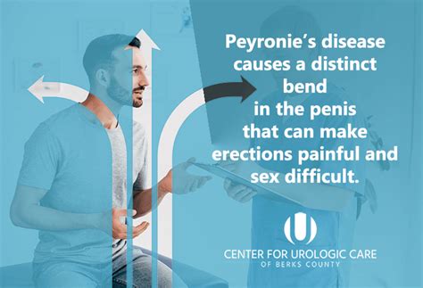 Smoking And Peyronies Disease At Irene Rayburn Blog