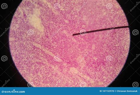 Cells Of A Human Thyroid Gland With Swelling Under A Microscope Stock