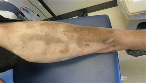 Painless Bruise Like Hyperpigmentation On A Woman With Lupus