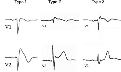 Long Term Prognosis Of Patients Diagnosed With Brugada Syndrome