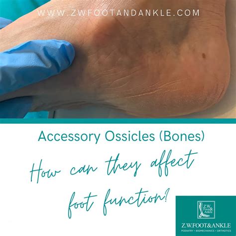 Accessory Ossicles Foot