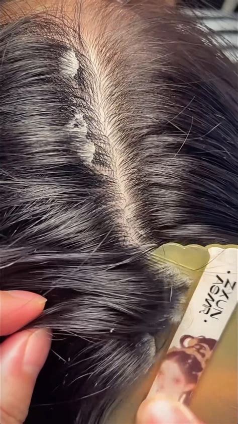 Scratching Psoriasis