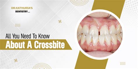 Lingual Crossbite Vs Buccal Crossbite