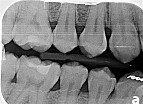 Got Diagnosed With Periodontitis X Rays R Dentalhygiene