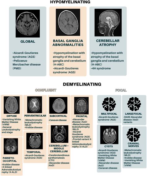 Classification Of Leukodystrophies In Hypomyelinating And Demyelinating Download Scientific