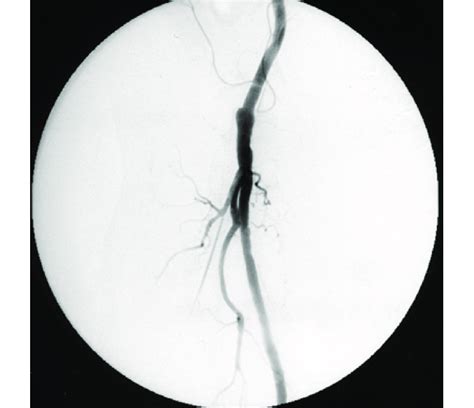 Postoperative Arteriogram Revealing The Disappearance Of The Deep