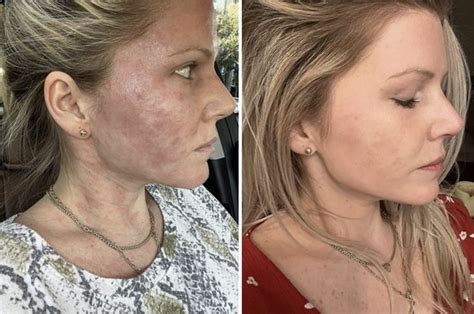 31 Skincare Products With Before And After Photos So Dramatic We Made