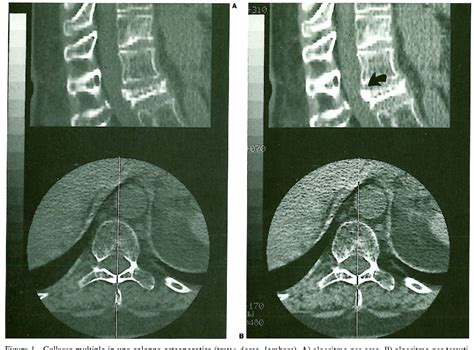Figure 1 From Il Collasso Vertebrale Semantic Scholar