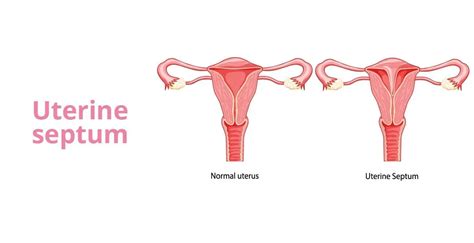 Understanding Uterine Septum Impact On Fertility