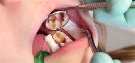 Bulimia Teeth 8 Warning Signs And Symptoms To Look For