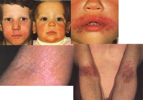 Types Of Dermatitis Flashcards Quizlet