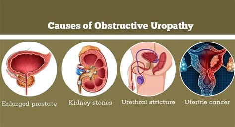 Obstructive Uropathy A Video Of Urinary Tract Blockage Science