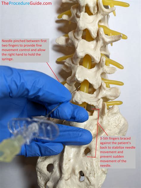 Epidural Needle