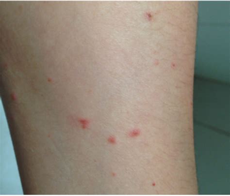 疱疹样皮炎局部症状图片有来医生