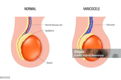 Varicocele Vector Comparison Of Normal Testicular Vein And Varicocele Testicular Disease Male