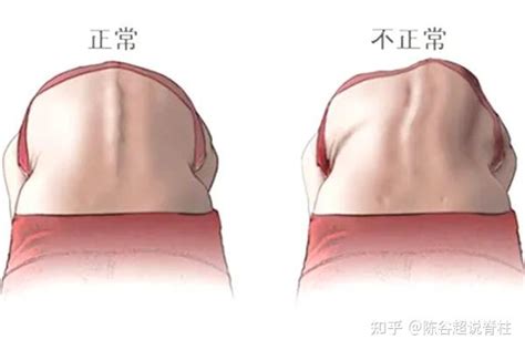 脊柱侧弯支具治疗怎么样？适用于一部分人群 知乎