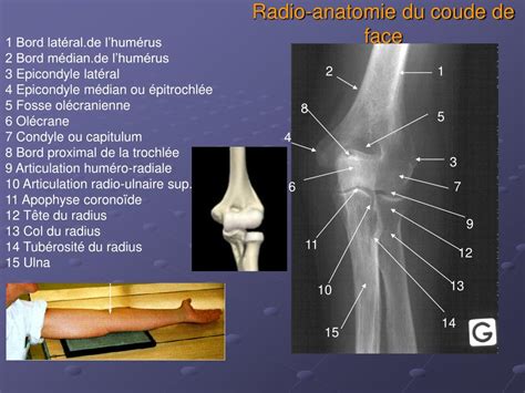Ppt Anatomie Radiologique Du Coude Powerpoint Presentation Free