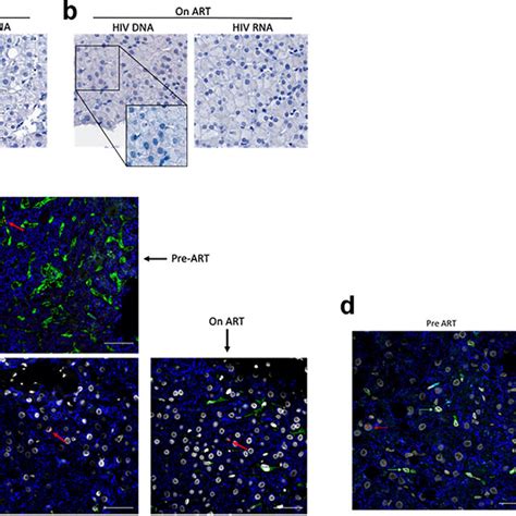 Hiv Dna Persists In Cd4 T Cells And Hepatocytes On Art Hiv Dna Or Hiv