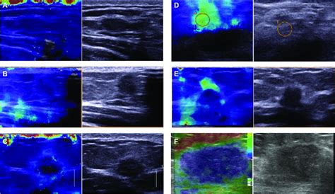 Representative Pictures For The Shear Wave Elastography Score Of Breast