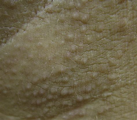Fox Fordyce Disease Apocrine Miliaria Journal Of Pediatric And