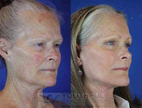 Co2 Laser Resurfacing Before And After Cnxjd