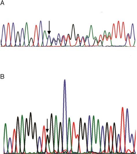 Molecular Analysis Of The Ctns Gene In Jordanian Families With