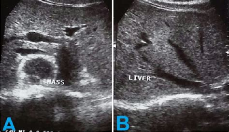 A B Abdominal Ultrasound Showing Homogeneous Mass Located At Right
