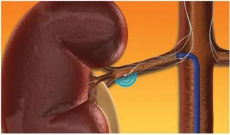 西部首例！新医大一附院起搏电生理团队成功开展肾交感神经消融术（rdn）治疗恶性心律失常 新疆医科大学第一附属医院