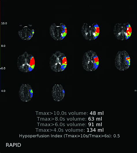 Role Of Hypoperfusion Intensity Ratio In Vessel Occlusions A Review On
