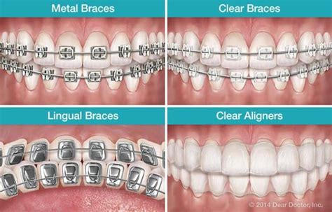 Types Of Dental Braces Metal Lingual Ceramic And Invisalign Thompson