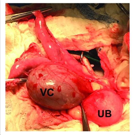 Cystic Vaginal Structure As Viewed In Surgery The Vaginal Cyst Vc