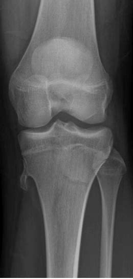 Osteochondrom Ortobas