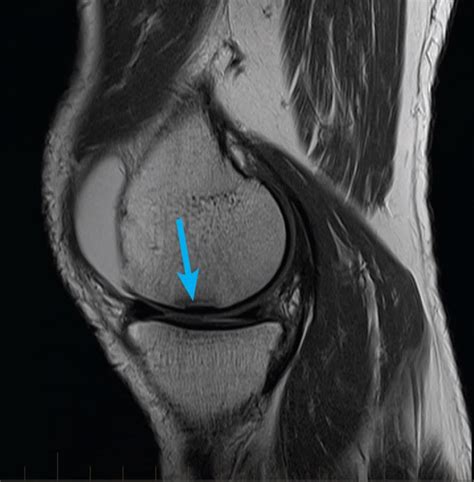 Mri Knee Meniscus Tear Mri At Melbourne Radiology Clinic