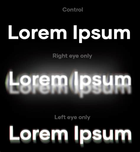 Is This Possibly Keratoconus Rkeratoconus